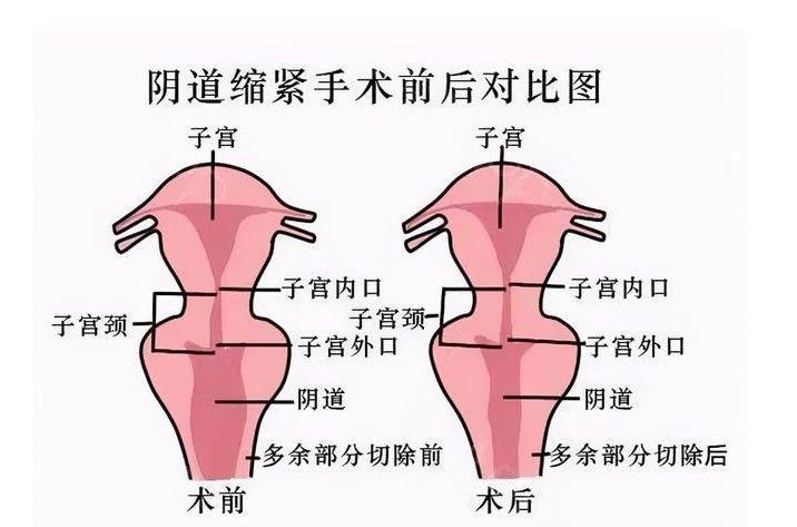 紧缩术后50天可以同房了吗图标