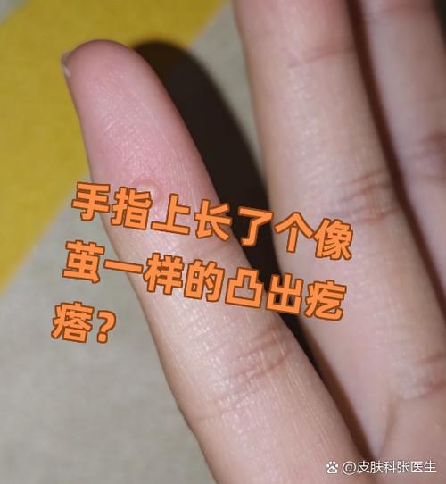 手指上长了个像茧一样的凸出疙瘩图标