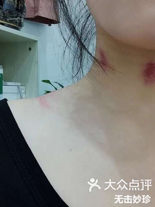 胸上的草莓印怎么去除