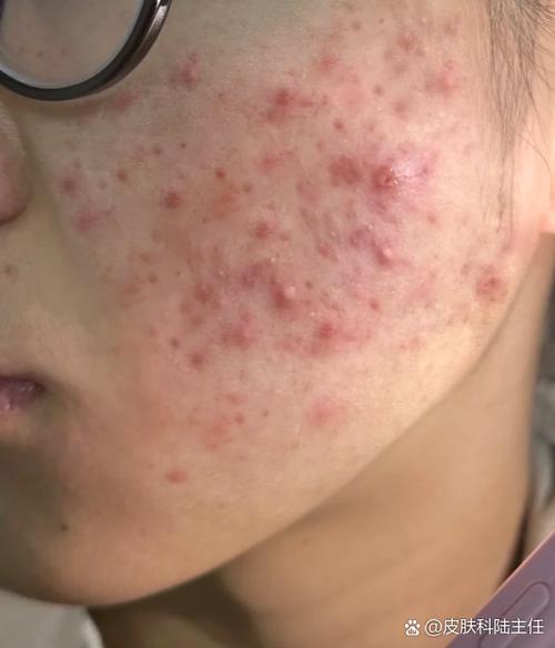 痘痘长不完图标