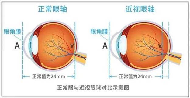大满贯控眼轴真的有效吗图标