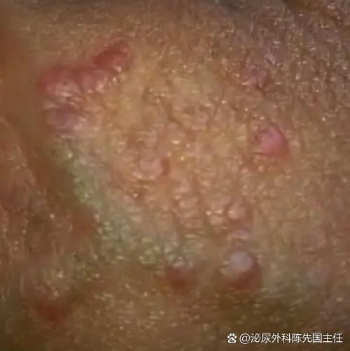 小弟上面长痘痘红肿图标