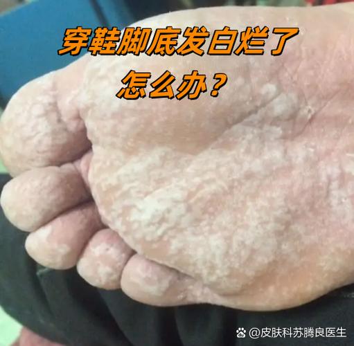 脚被真菌感染图标