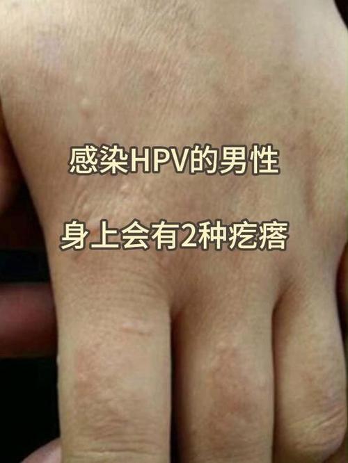 男性hpv有什么症状图标