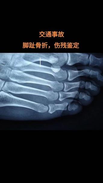 足趾骨折伤残评定截图