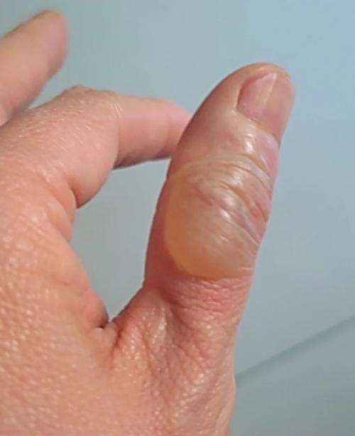 手上烫起的泡怎么办可以弄破吗截图