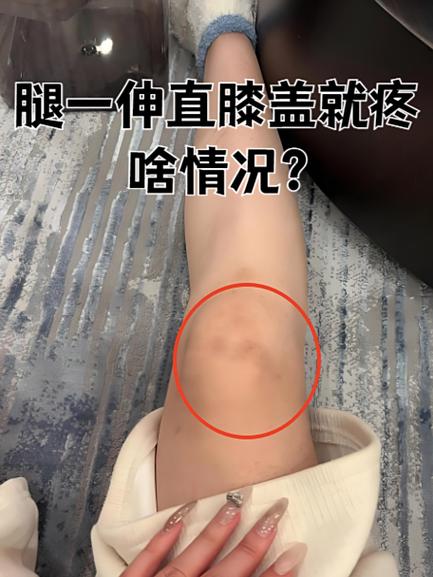 蹬腿膝盖疼是怎么回事截图