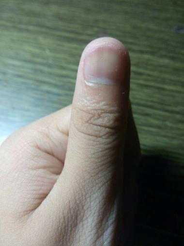 大拇指竖纹特别严重截图