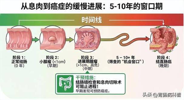 肠息肉从无到有需要多久图标