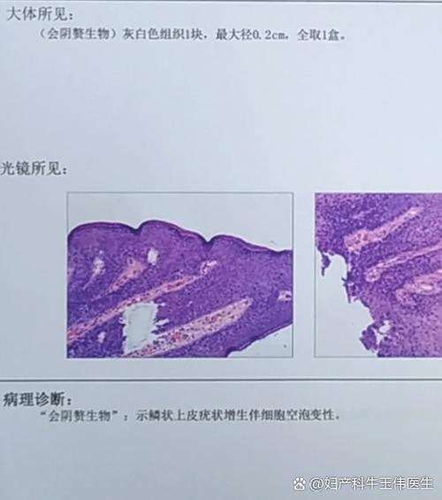 阴口边上长了个肉疙瘩什么原因图标