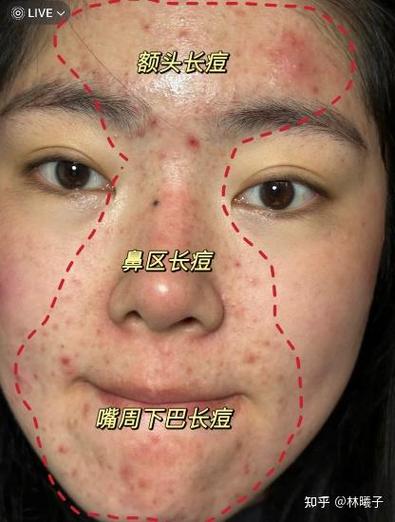 脸上长痘什么原因图标