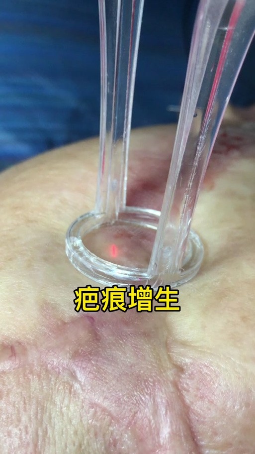 十几年的疤痕能去除吗图标