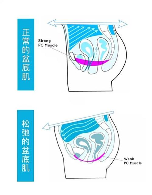 盆底肌松弛怎么修复图标