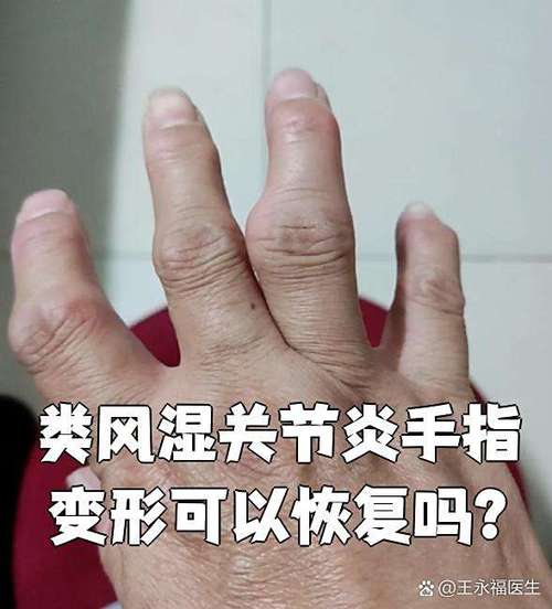 手指变形了还能恢复吗图标