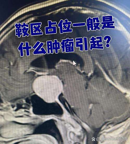 鞍上区占位一般是什么肿瘤截图