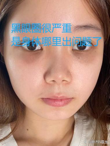眼睛周围有黑眼圈图标