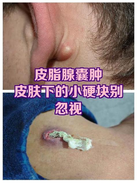 表皮囊肿会自己消失吗图标