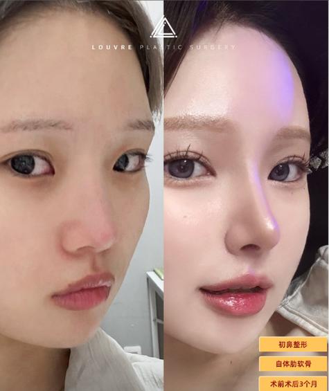 为什么不建议做肋骨鼻图标
