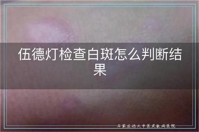 11屏幕出现白斑的原因图标