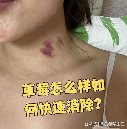 草莓痕迹怎么快速消除图标