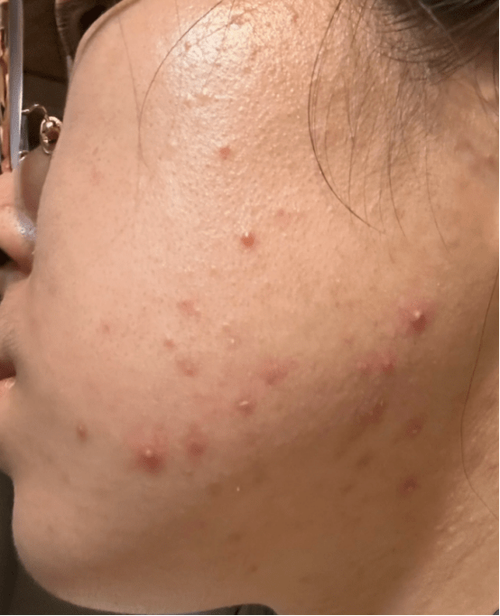 女生说长痘痘了怎么哄图标