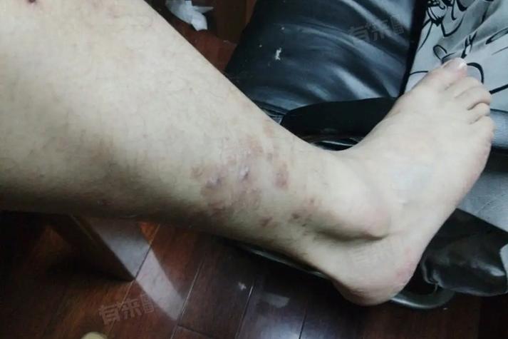 小腿很痒抓后一粒粒凸起截图