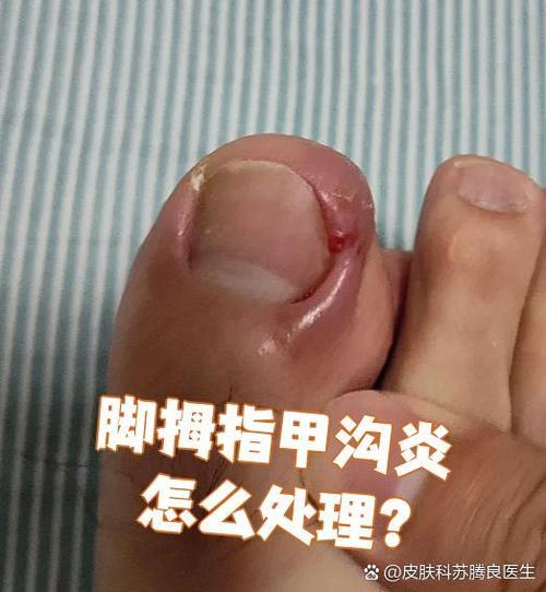 甲沟炎修脚有用吗图标