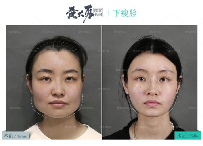 脸方又不敢削骨怎么办图标