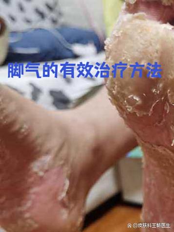 去除脚气真菌最好的方法图标