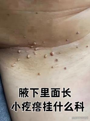 女性外部有小疙瘩是什么原因截图