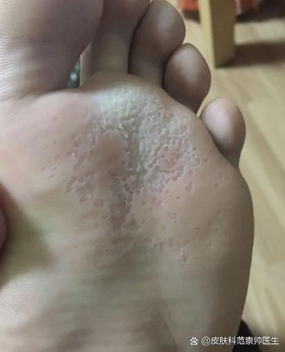 脚底真菌感染是什么原因引起的图标