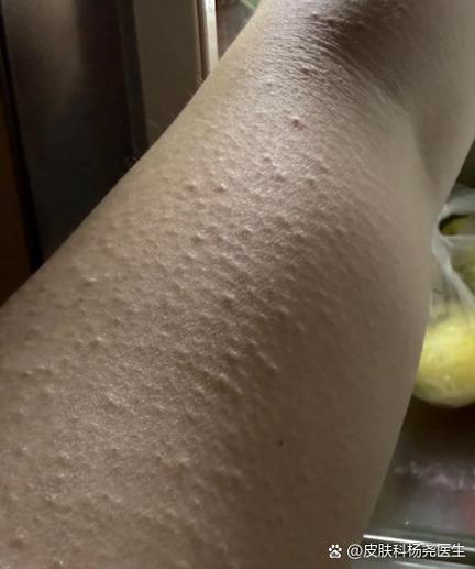 皮肤像小米粒疙瘩特别痒图标