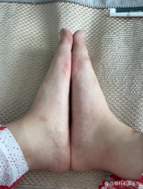 三种人不宜穿增高鞋截图