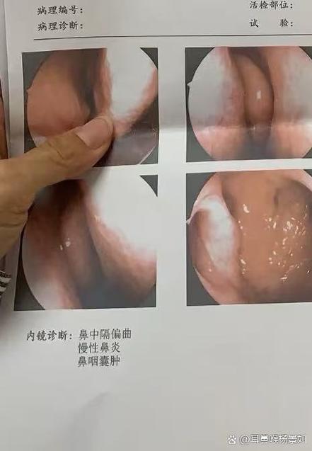 老流鼻血是怎么回事图标