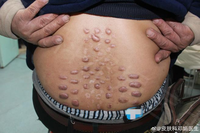 疤痕增生图片真实照片图标