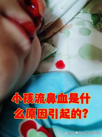 小孩发烧流鼻血是什么原因图标