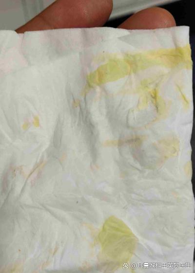 单侧鼻子突然流黄水截图