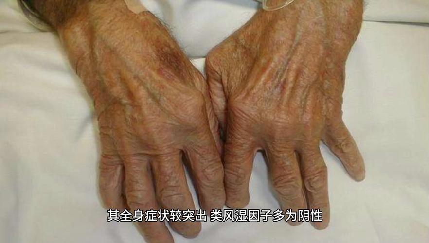 成人斯蒂尔病十大忌口图标