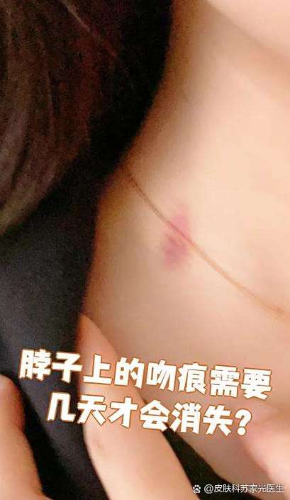 上帝的吻痕