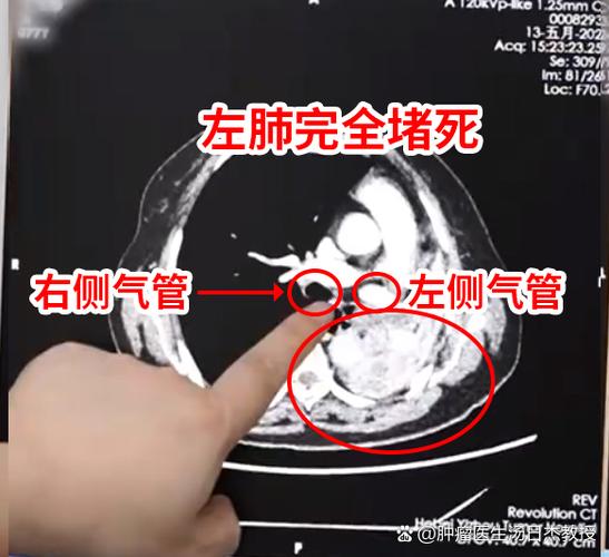 八十岁老人肺上有肿瘤怎么办图标