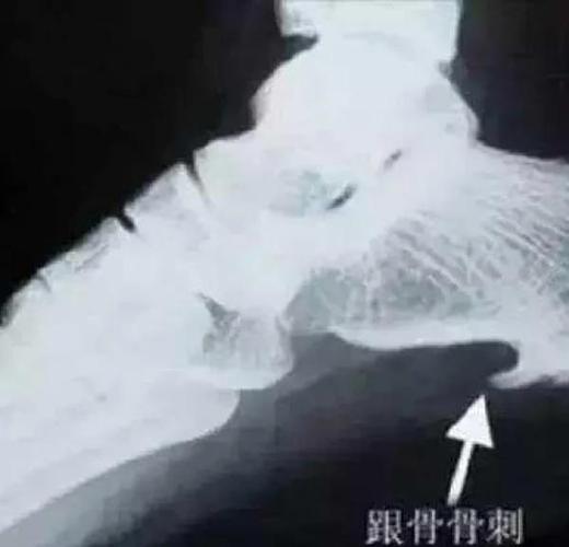 什么是骨刺有什么症状截图