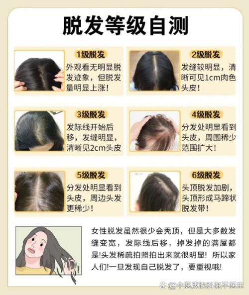 脱发严重是什么原因引起的截图