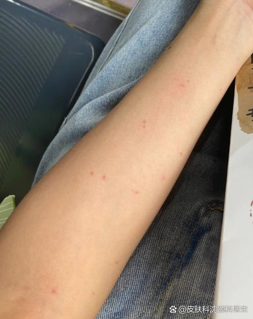 胳膊上有小红点图片图标