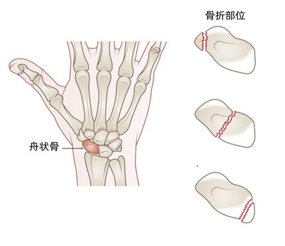 手舟骨骨折固定位置