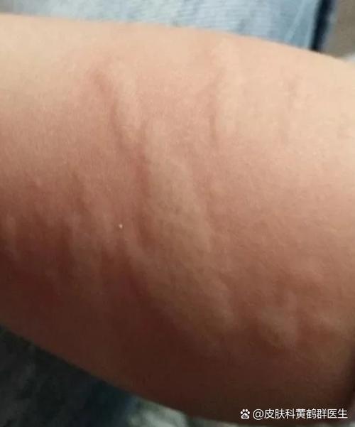 身上一挠痒痒就起疙瘩图标
