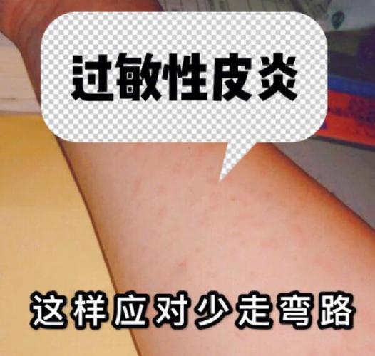剥了橘子手发红要警惕图标