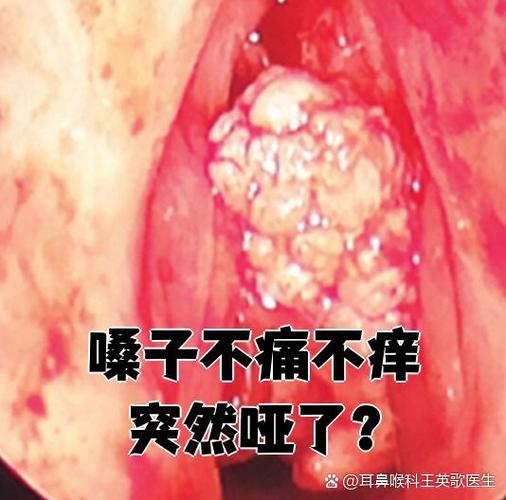 喉咙不痛但声音沙哑图标