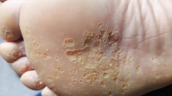蜂窝状脚气图标