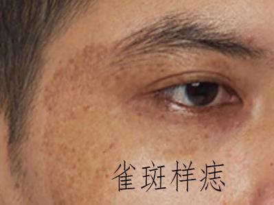 脸上褐色的斑点是什么图标