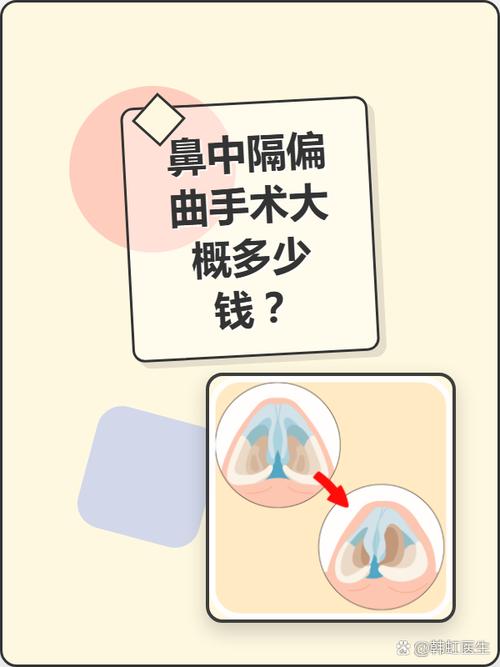 鼻中隔偏曲手术大概多少钱图标